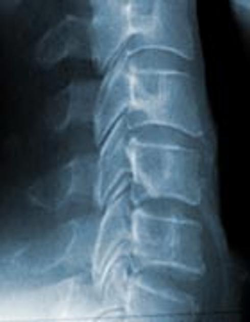 Yläraajan tekonivelet alkaneet parantua laadultaan | Terve.fi