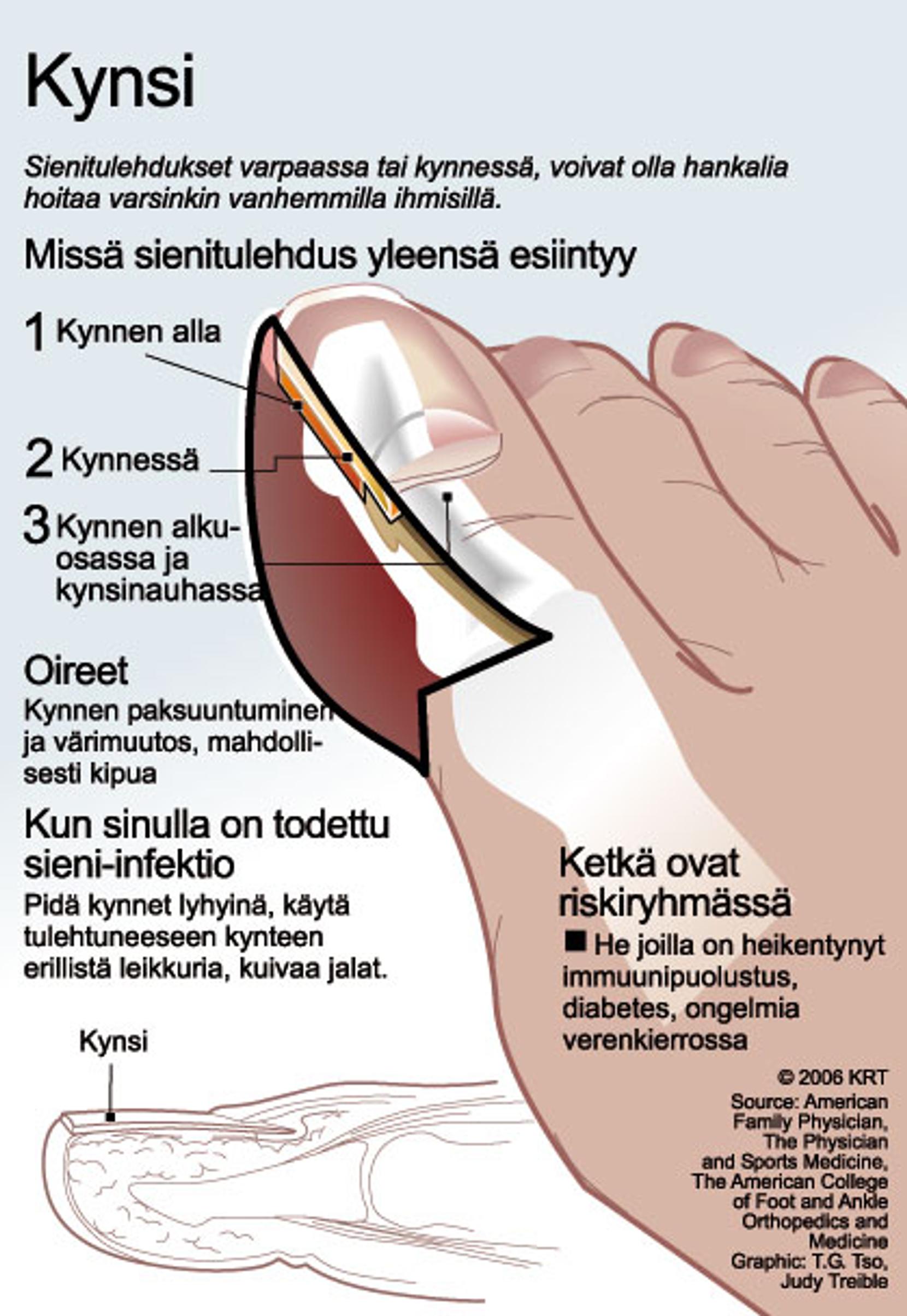 Infografiikka - Kynsisieni | Terve.fi