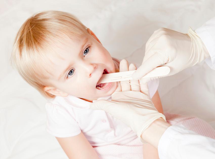 Angiina eli streptokokki A -bakteerin aiheuttama nielutulehdus vaatii ...