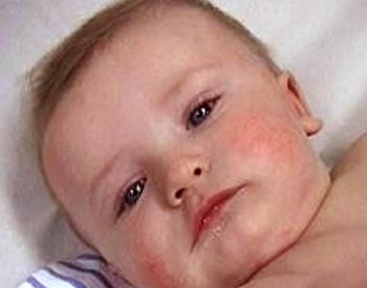 Lasten atooppinen ihottuma | Terve.fi