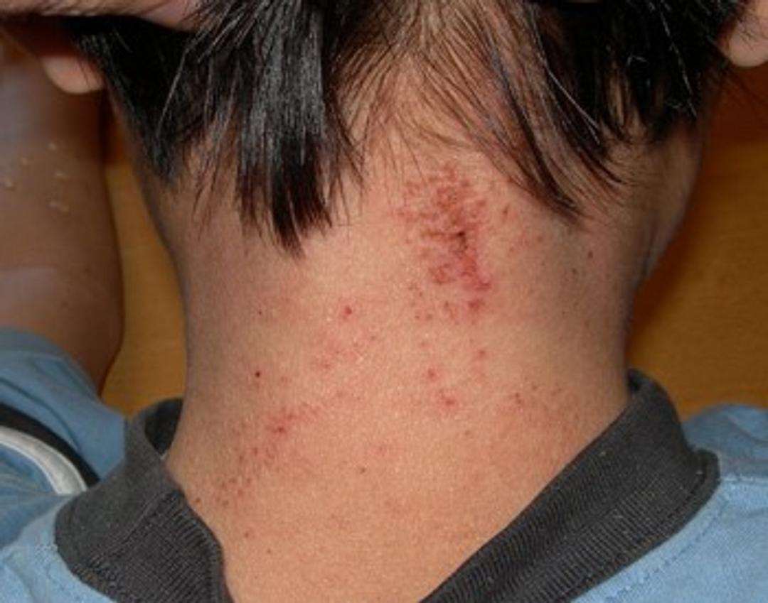 Lasten atooppinen ihottuma | Terve.fi