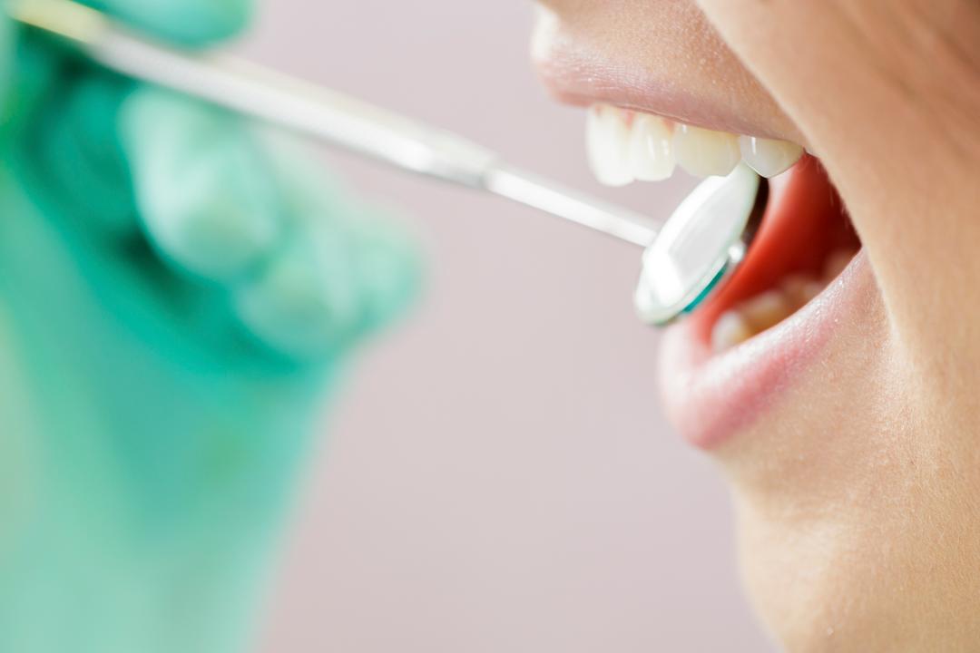 Joka kymmenenneltä työikäiseltä puuttuu omat hampaat | Terve.fi