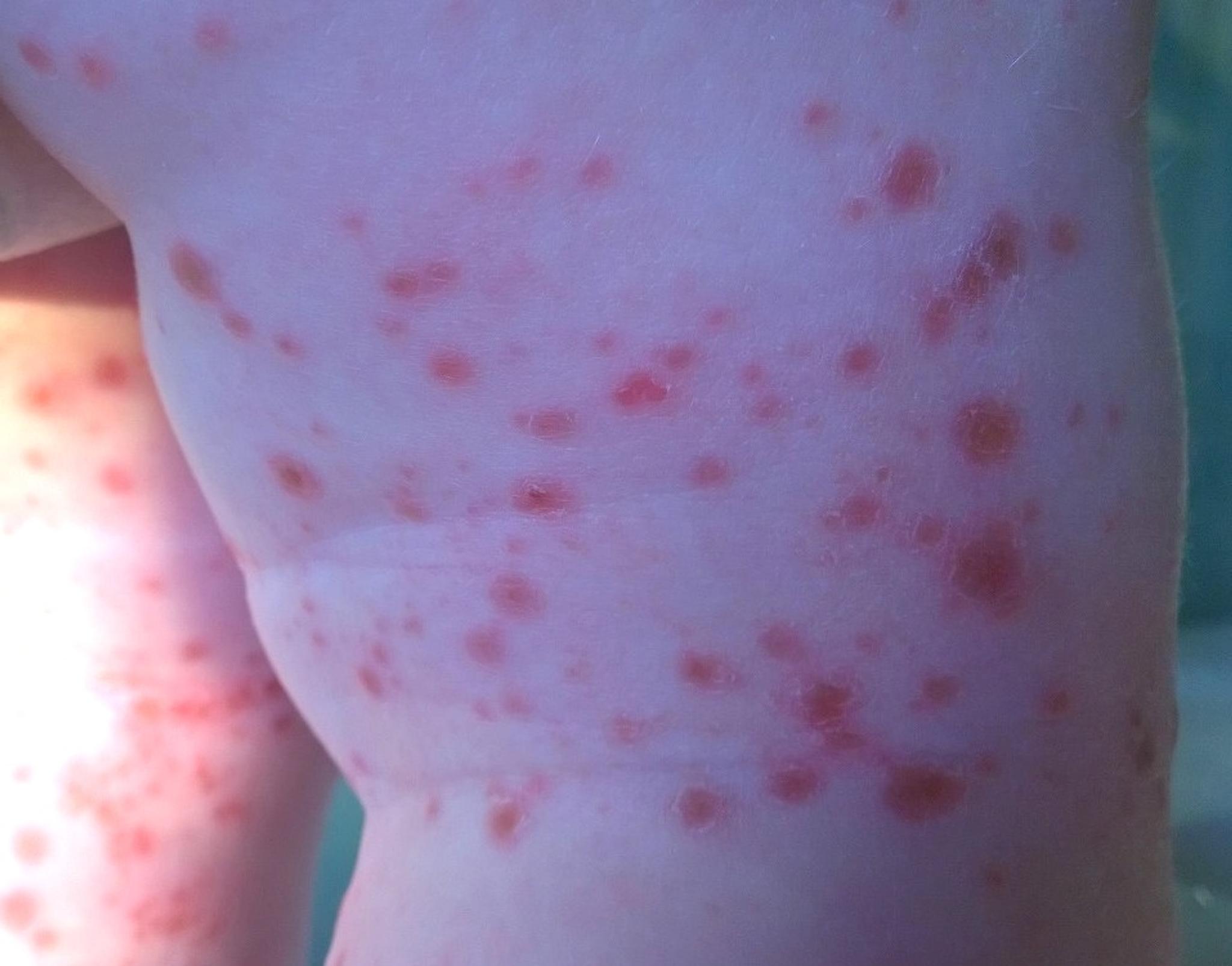 Yleiset tulehdukset, joihin liittyy laajalle levinnyt ihottuma | Terve.fi