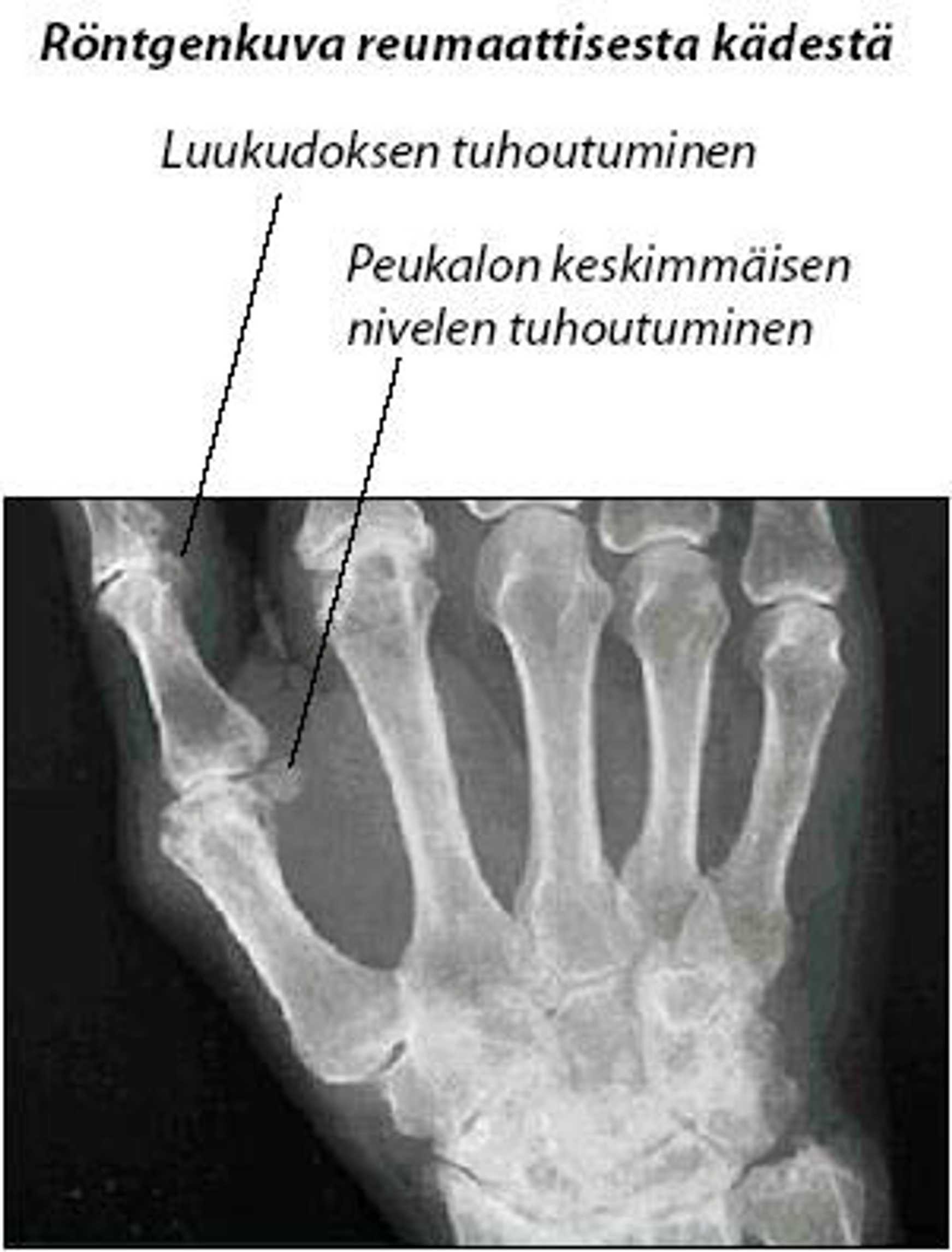 Nivelreuma eli reumatoidi artriitti | Terve.fi