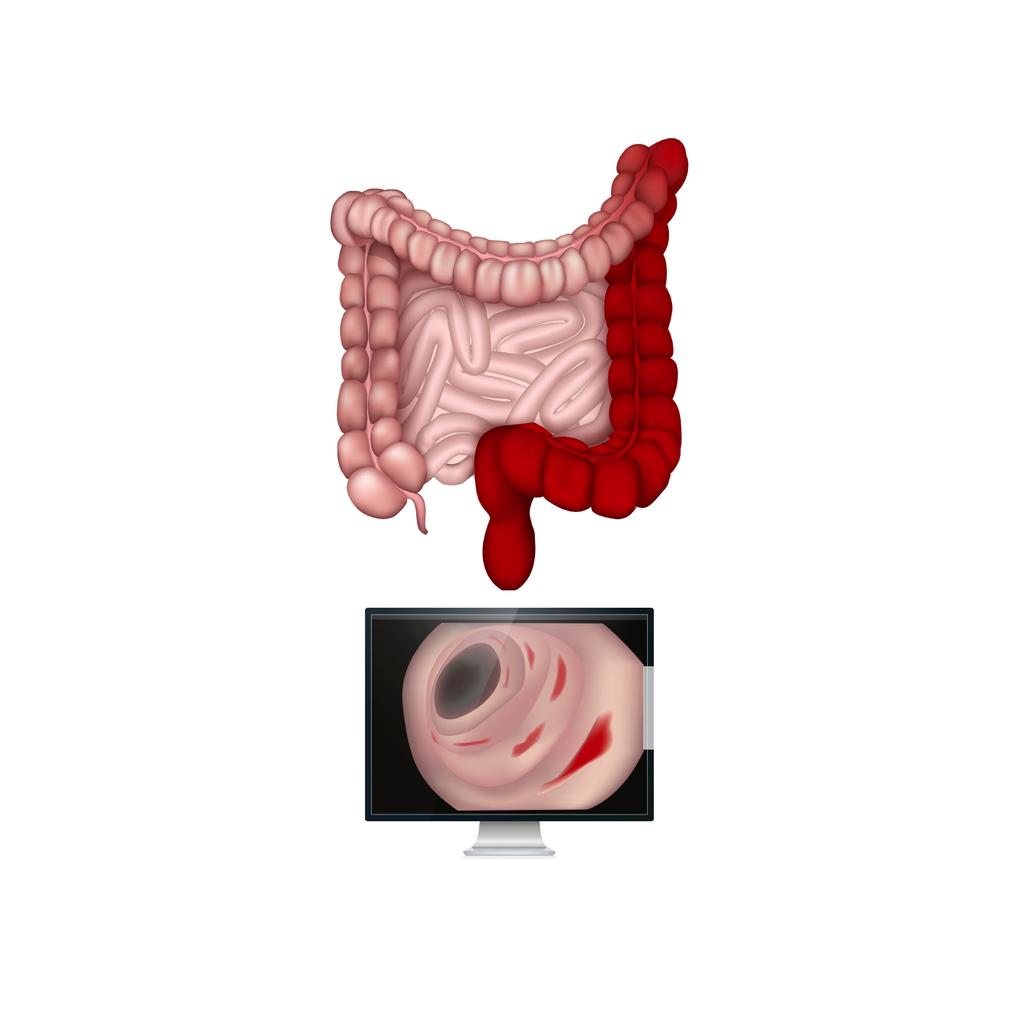 Haavainen paksusuolentulehdus | Terve.fi