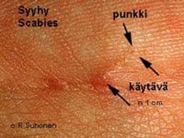 Hyönteispuremat | Terve.fi
