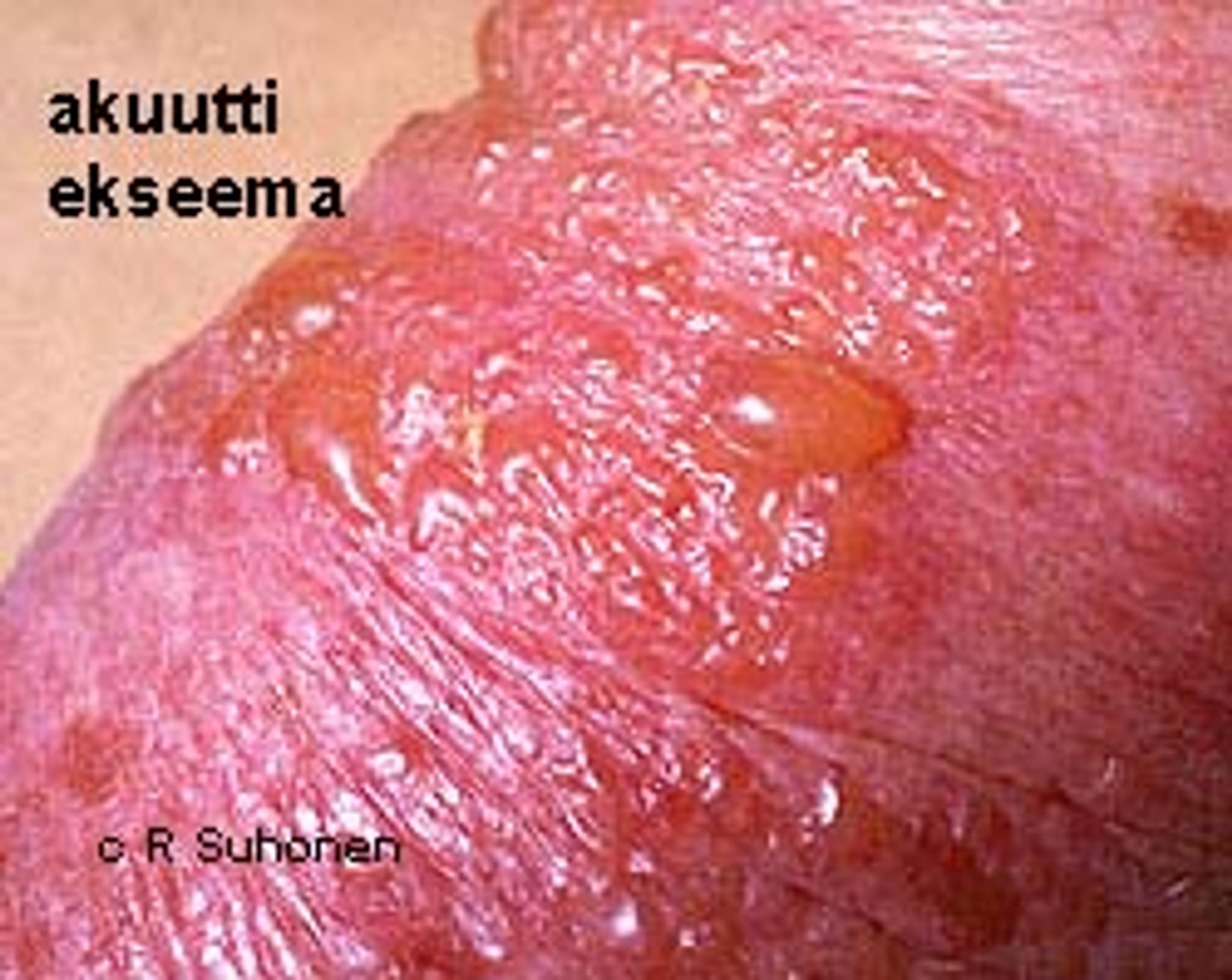 Ekseema - mitä se on? | Terve.fi