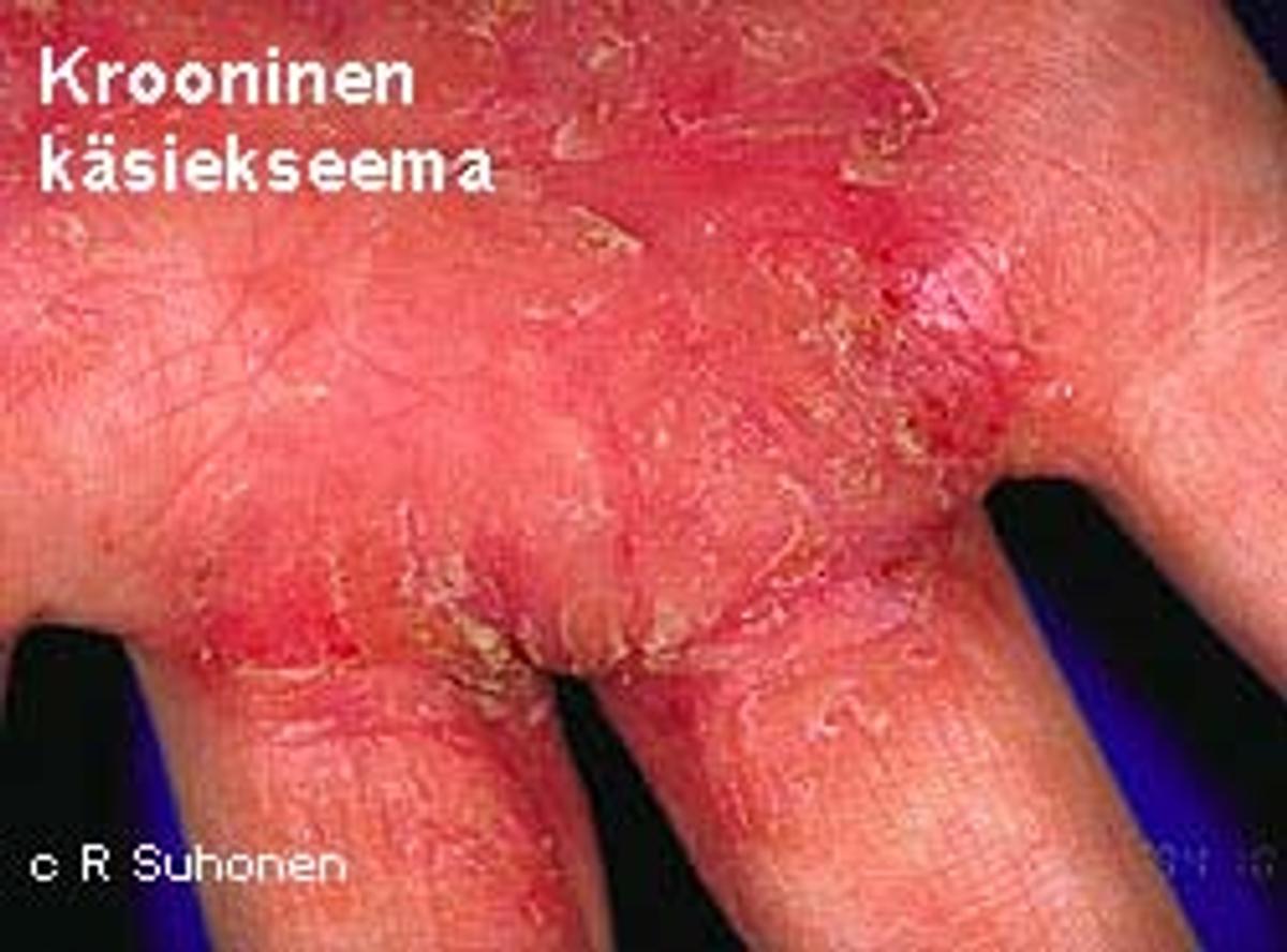 Ekseema - mitä se on? | Terve.fi