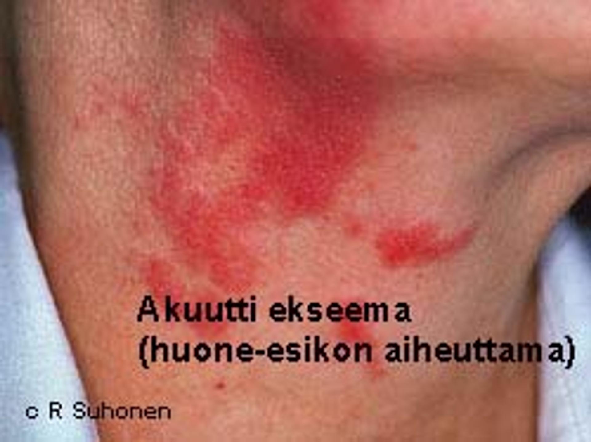 Ekseema - mitä se on? | Terve.fi