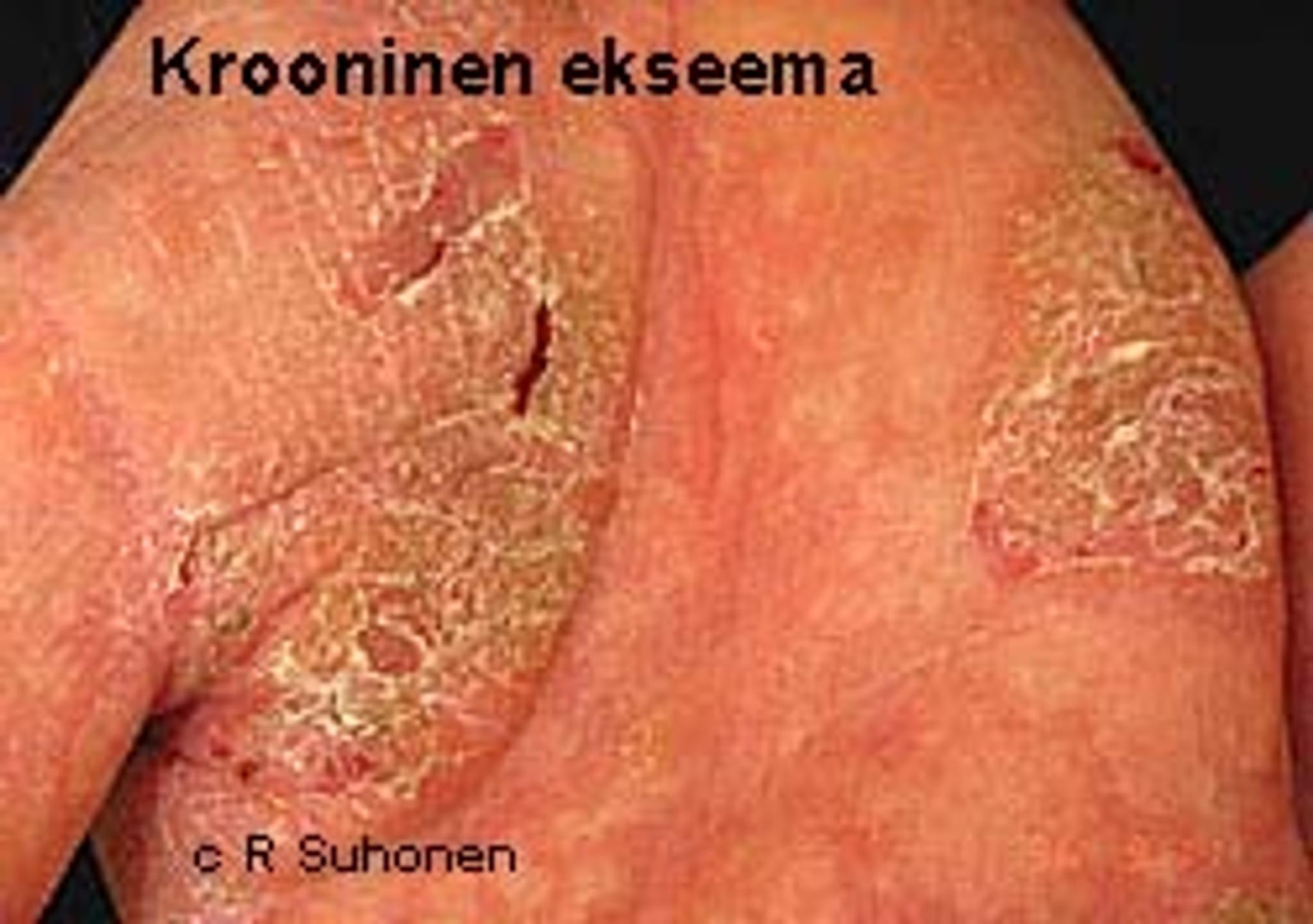 Ekseema - mitä se on? | Terve.fi