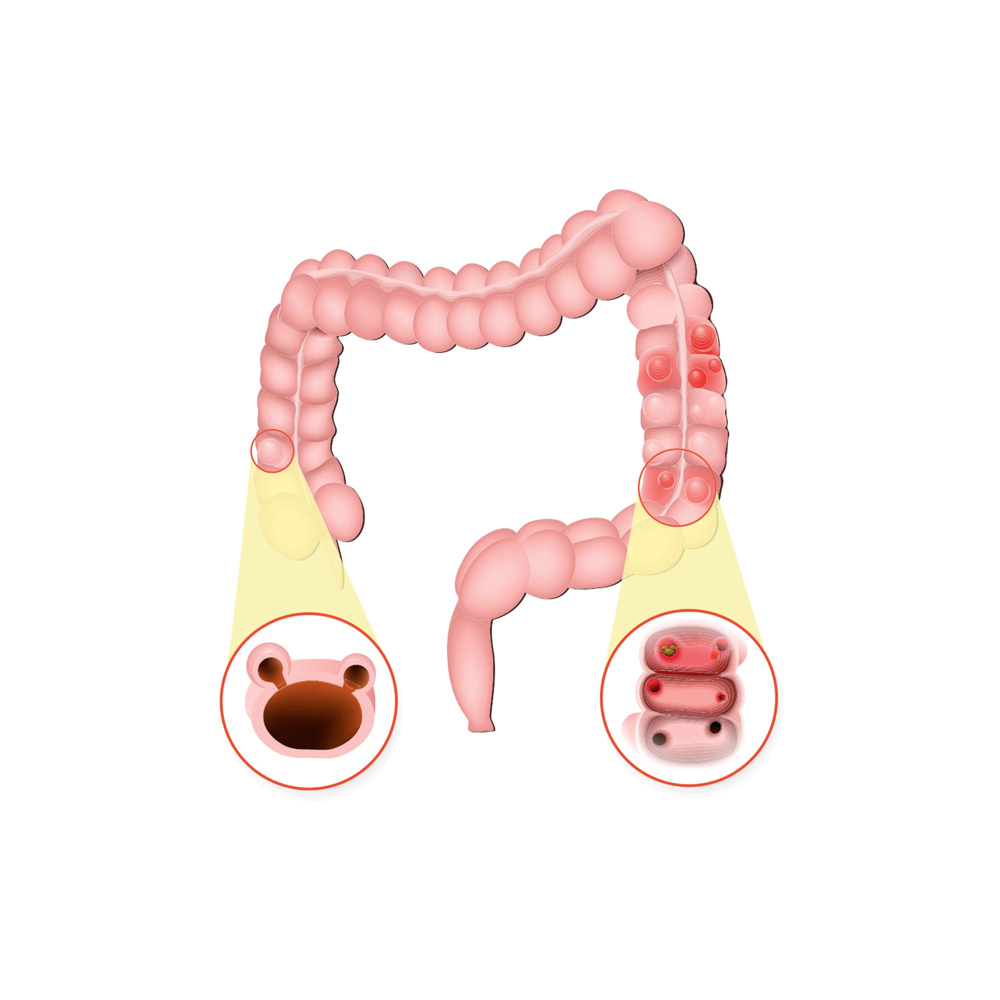 Divertikuliitti | Terve.fi