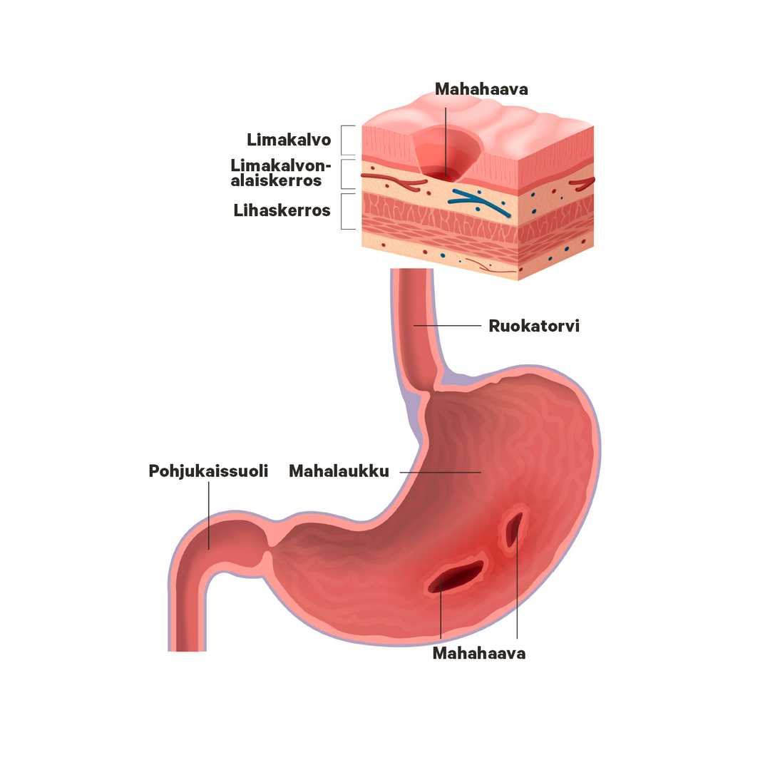 Mahahaava | Terve.fi