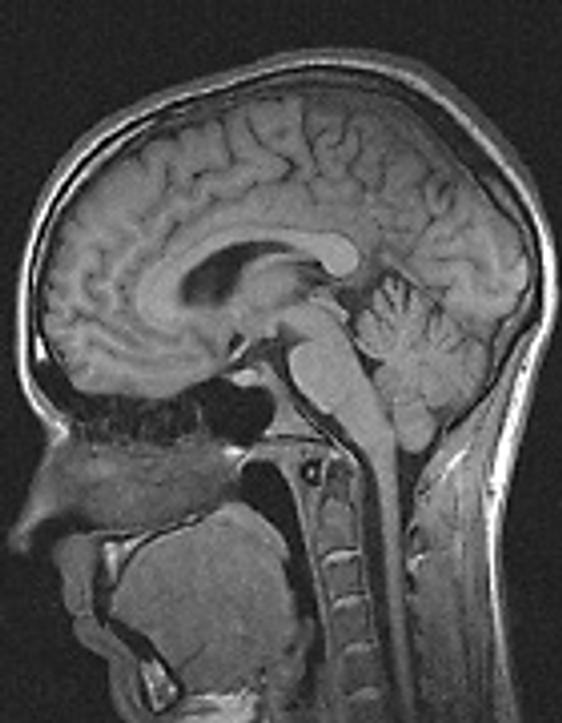 Sukulaisen Parkinsonin tauti kertoo dementiavaarasta | Terve.fi