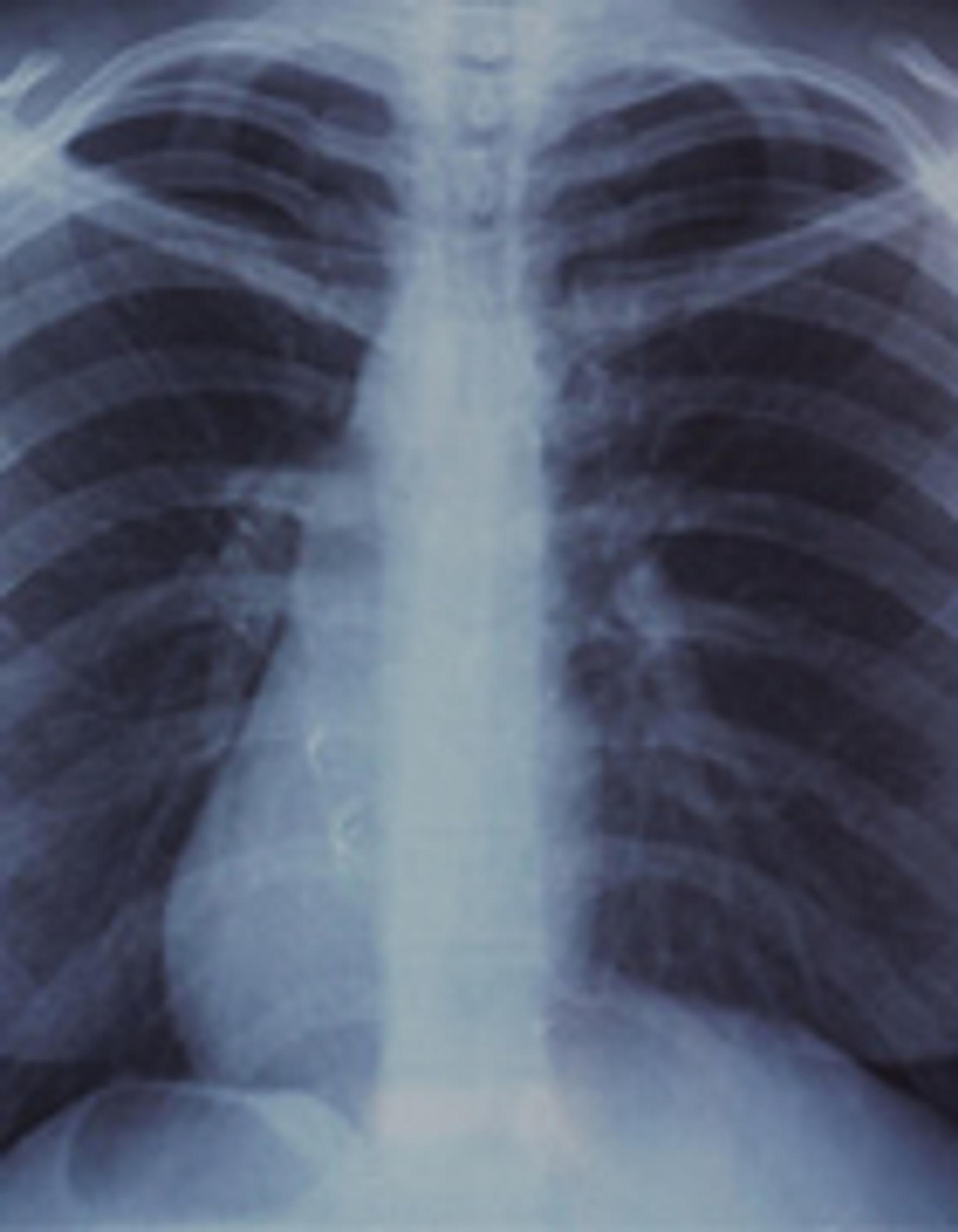 Vaikeahoitoinen tuberkuloosi riehuu maailmalla | Terve.fi